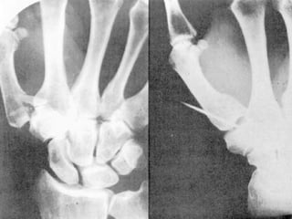 Thumb fractures | PPT | Death, Injury, or Military Conflict | Sensitive ...