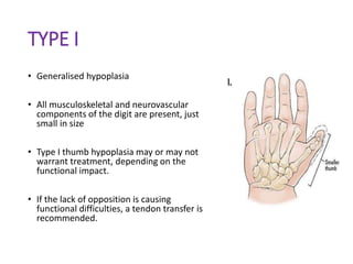 THUMB HYPOPLASIA- Eknath.pptx