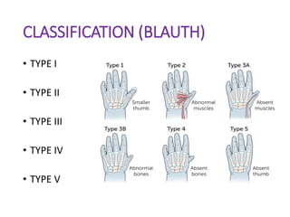THUMB HYPOPLASIA- Eknath.pptx