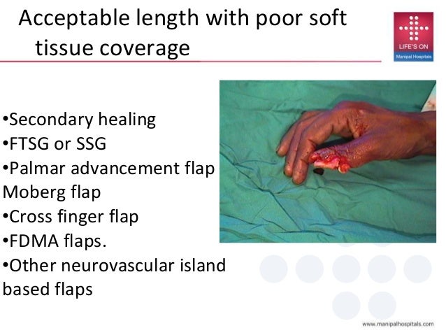 Thumb reconstruction