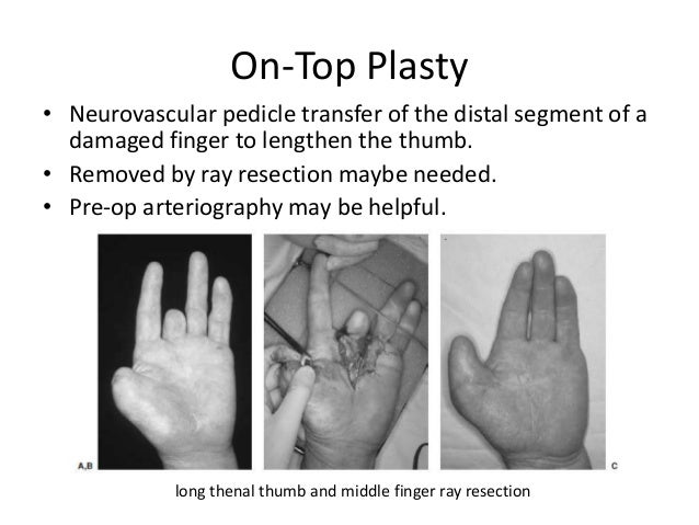 Thumb reconstruction
