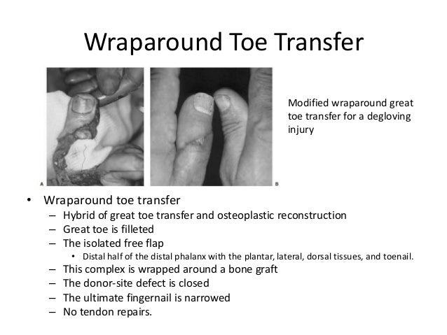 Thumb reconstruction