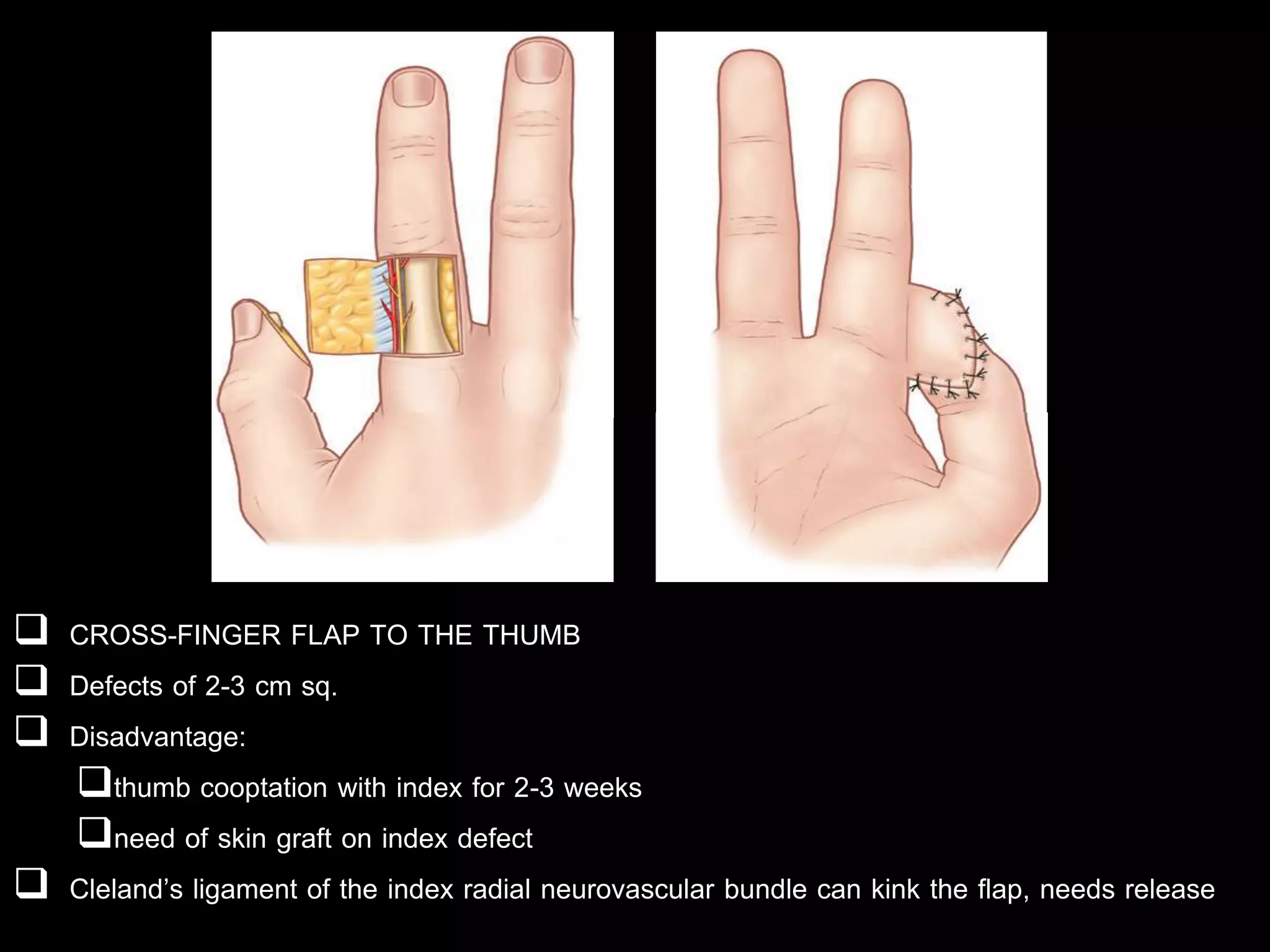 Thumb reconstruction | PPTX