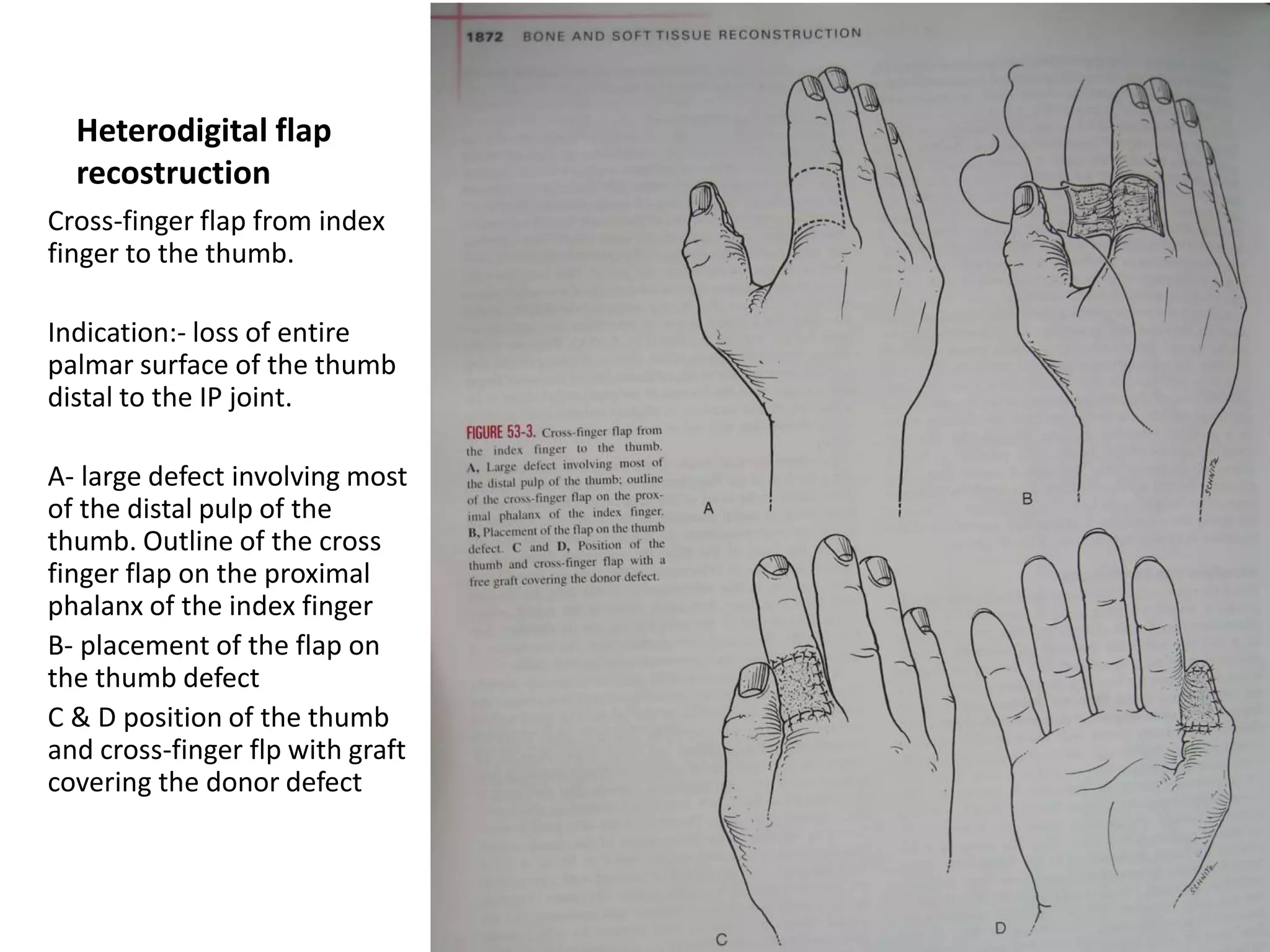Thumb reconstruction by conventional technique. | PPTX