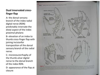Thumb reconstruction by conventional technique. | PPTX