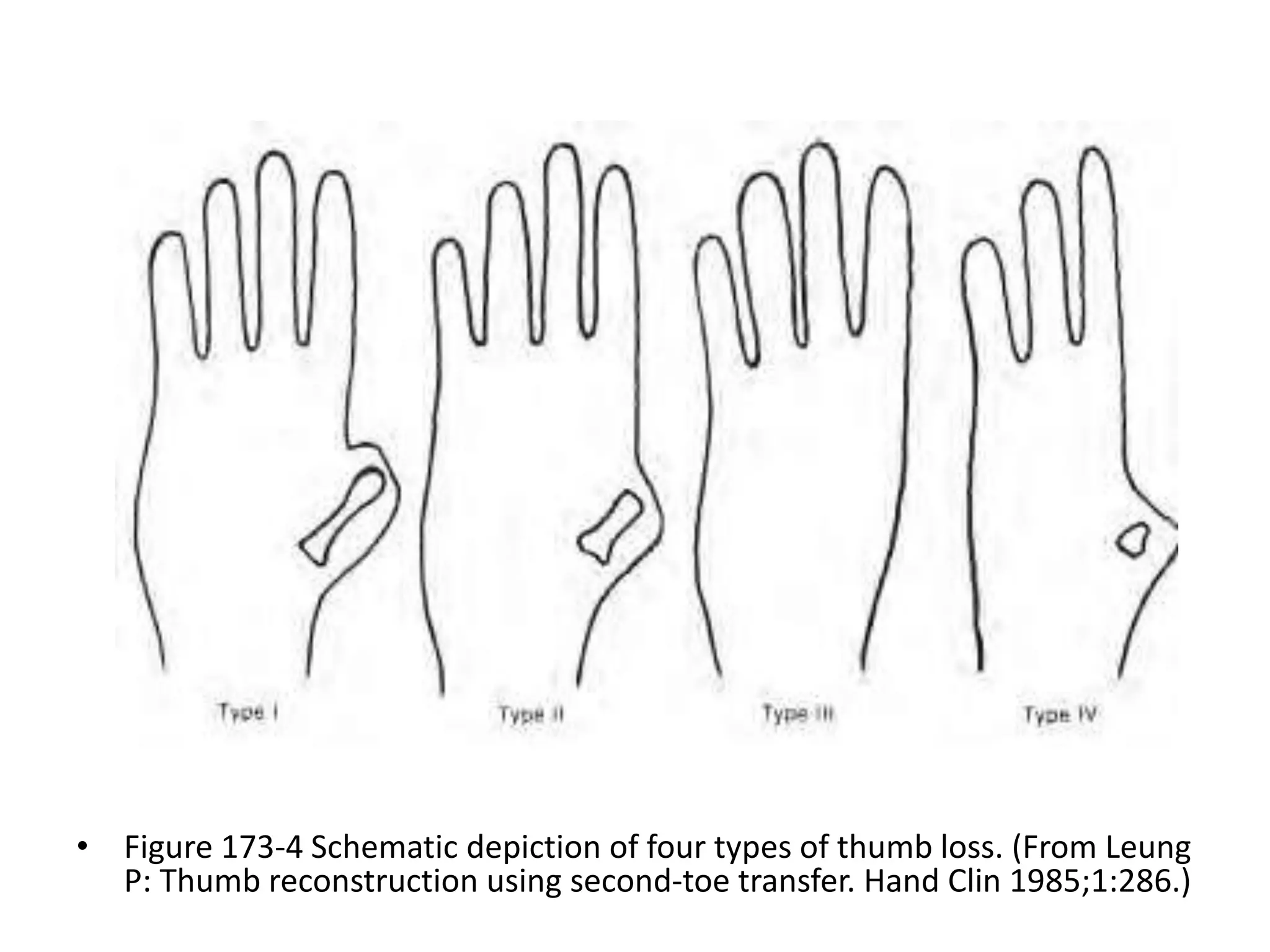 Thumb reconstruction by microvascular methods | PPT