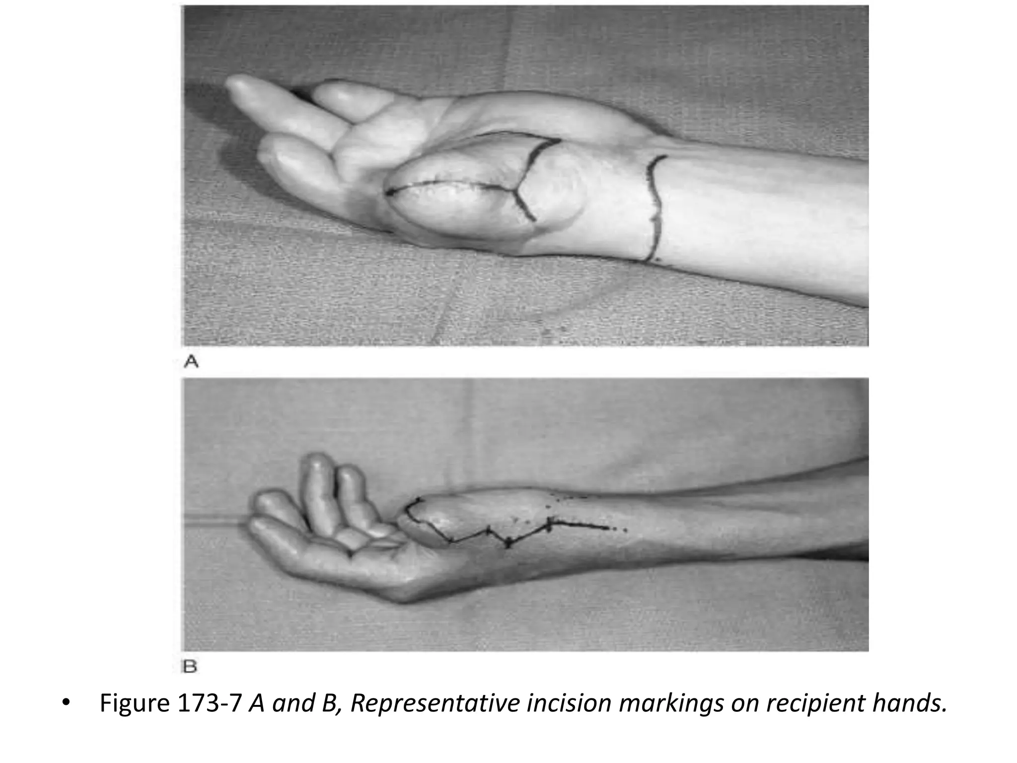 Thumb reconstruction by microvascular methods | PPT