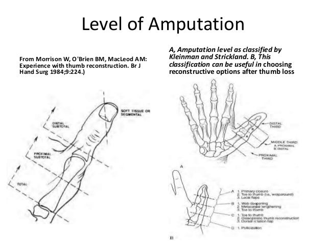 Thumb reconstruction by microvascular methods