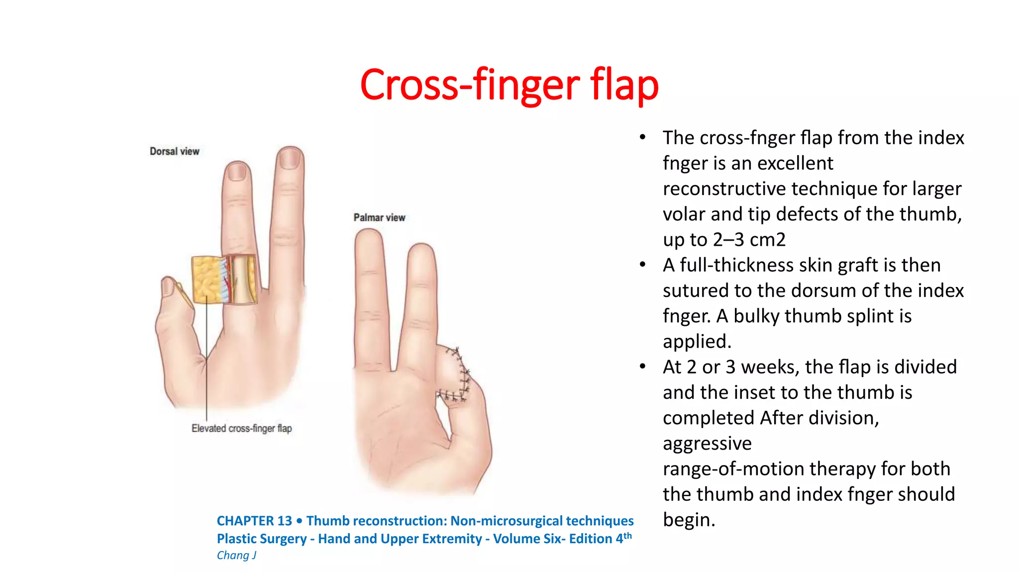 Thumb soft tissue defects | PPTX