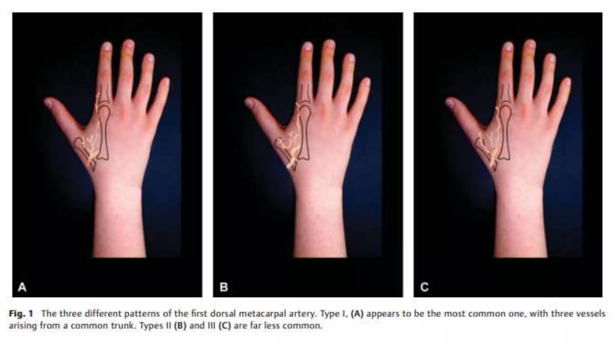 Thumb soft tissue defects | PPTX