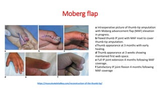 Thumb soft tissue defects | PPTX