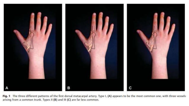 Thumb soft tissue defects | PPT