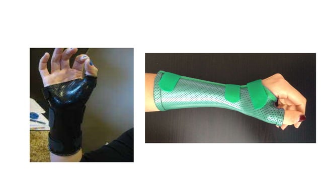 THUMB SPICA SPLINT 2.pptx