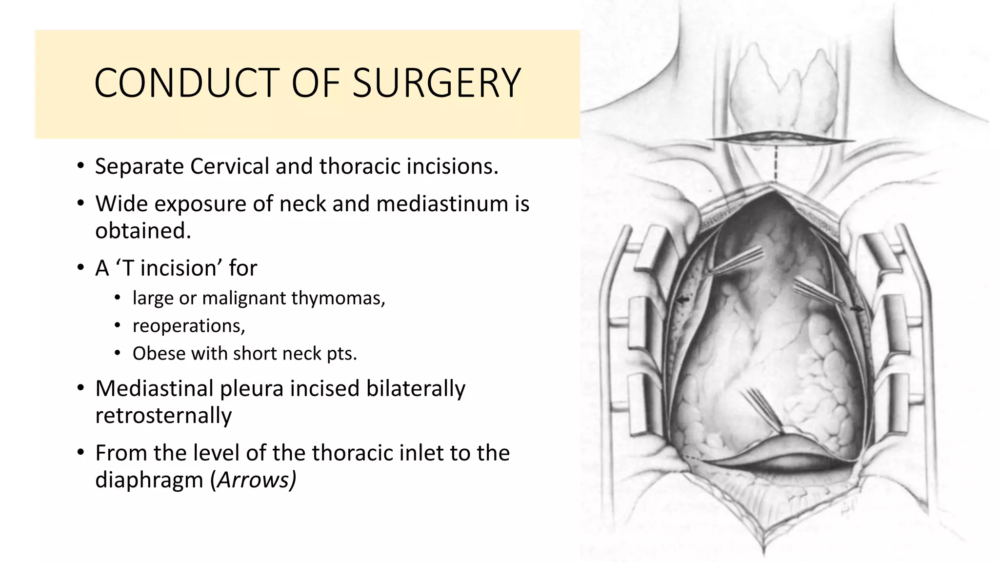 Thymic Disorders - Clinical Implications & Management Principles.pptx