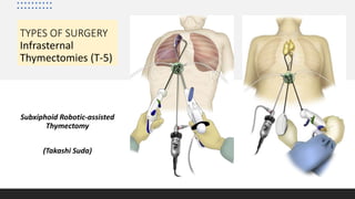Thymectomy & Thymic Disorders - Clinical Implications, Multimodal and ...