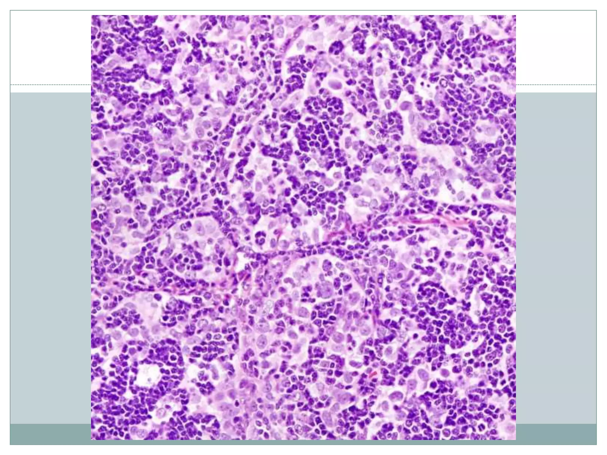 Thymoma | PPTX