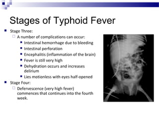 Typhoid fever | PPT