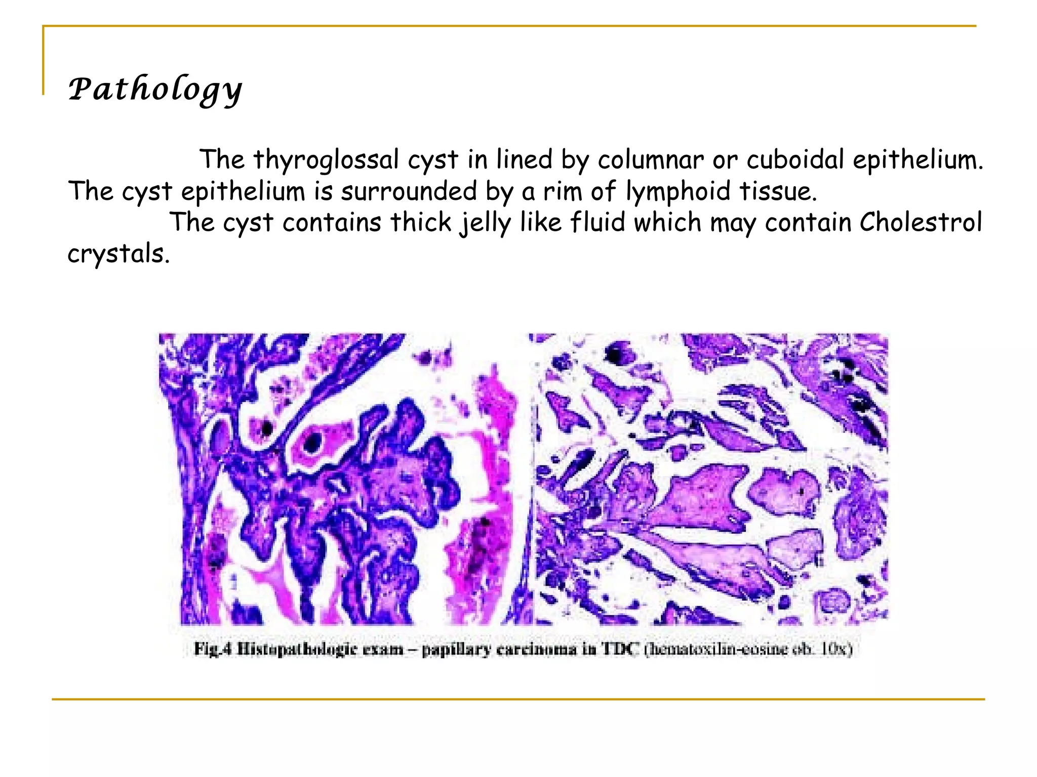 Thyroglossalcyst | PPT