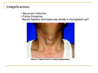 Thyroglossalcyst | PPT