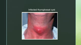 Thyroglossal Cyst 2022.pptx | Thyroid Disorders | Endocrine and Metabolic Diseases