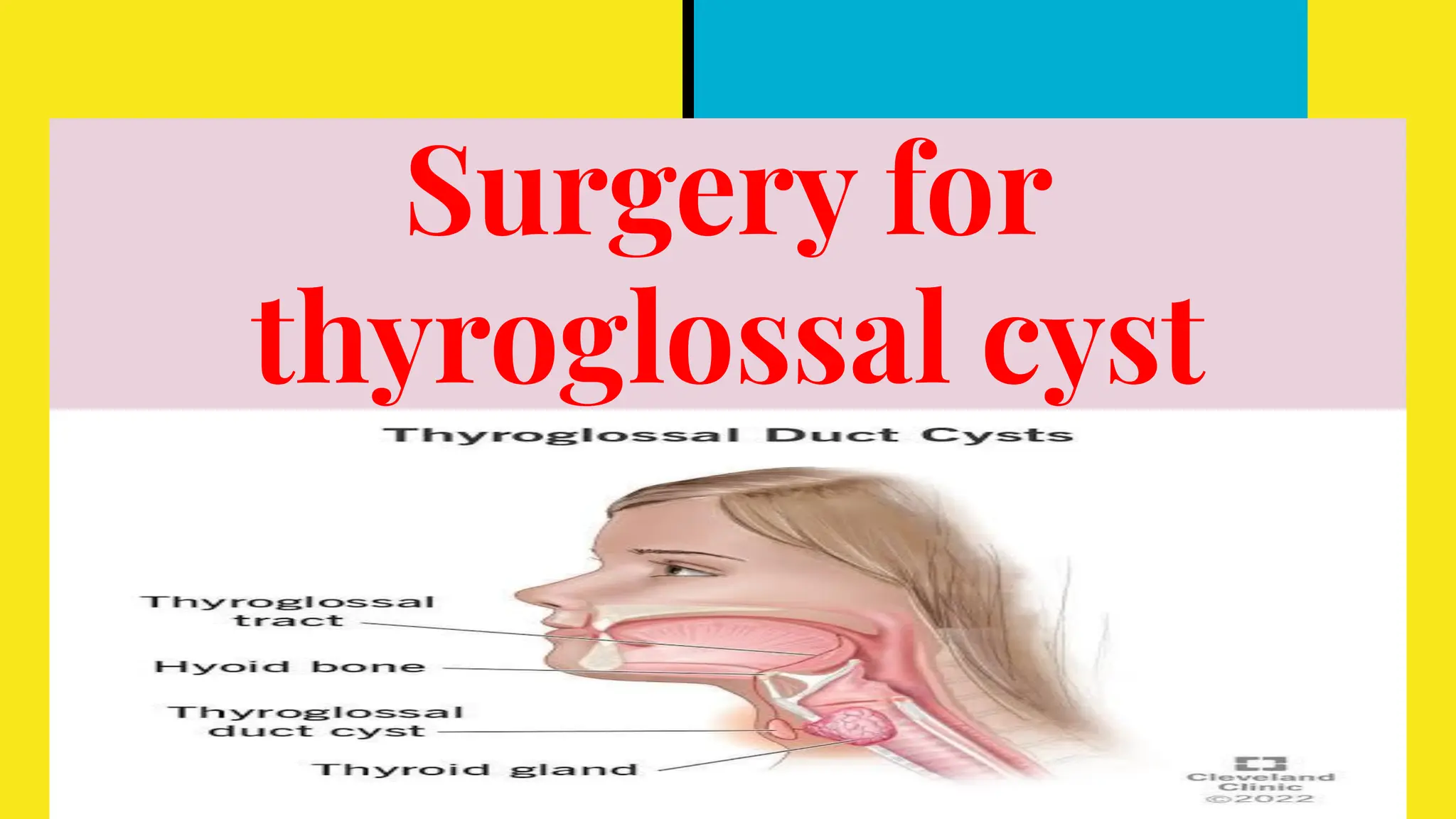 Thyroglossal duct | PPT