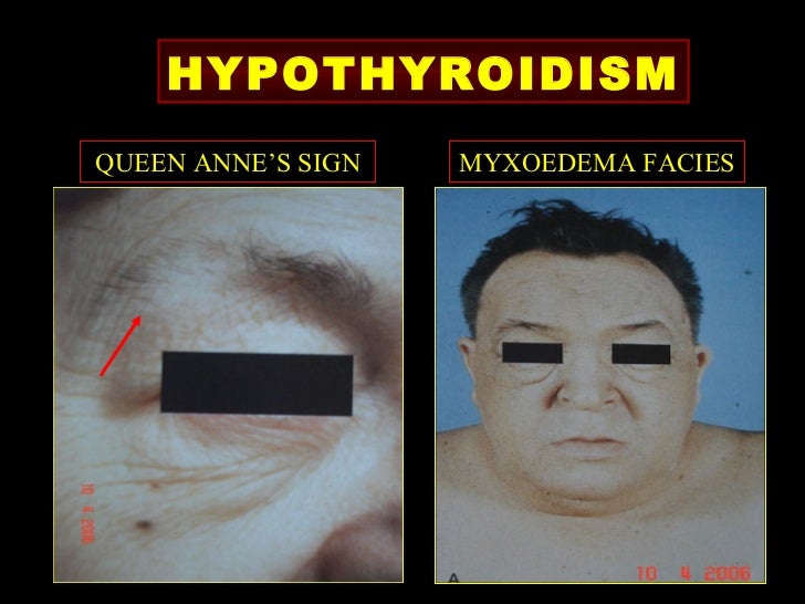 Medical management of Thyroid disease