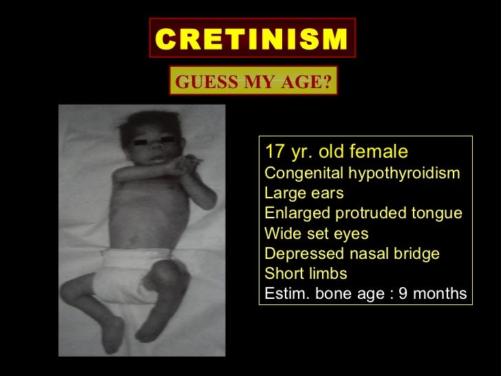 Medical management of Thyroid disease