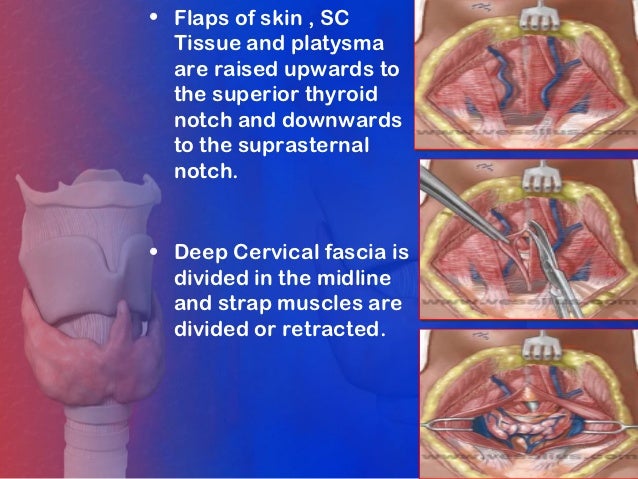 Thyroid surgery and neoplasms of thyroid