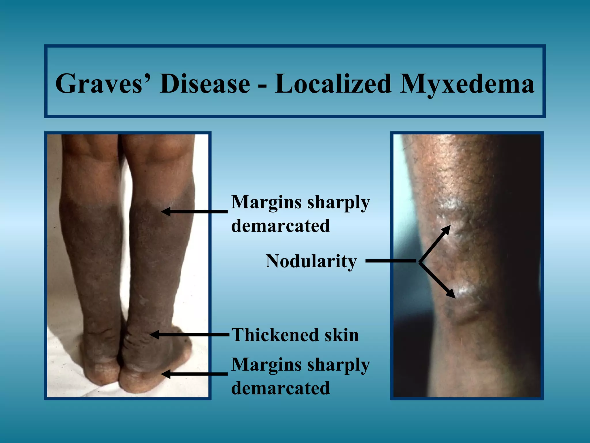 Hypothyroidism Signs and Symptoms Hypothyroidism Signs and Symptoms | PPT
