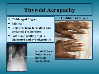 Hypothyroidism Signs and Symptoms Hypothyroidism Signs and Symptoms | PPT