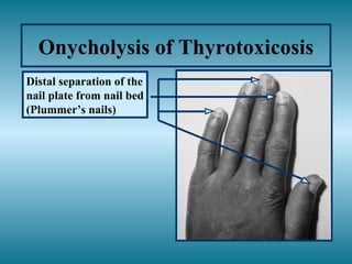 Hypothyroidism Signs and Symptoms Hypothyroidism Signs and Symptoms | PPT