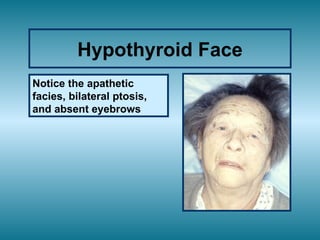 Hypothyroidism Face Swelling