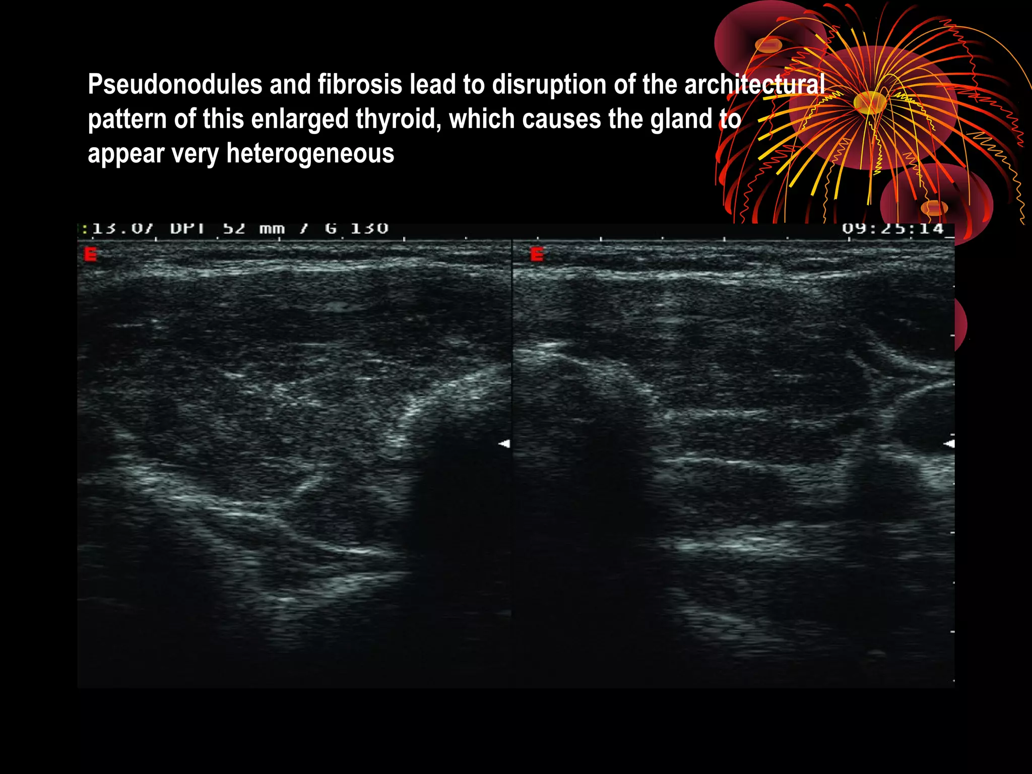 Thyroid ultrasound | PPT