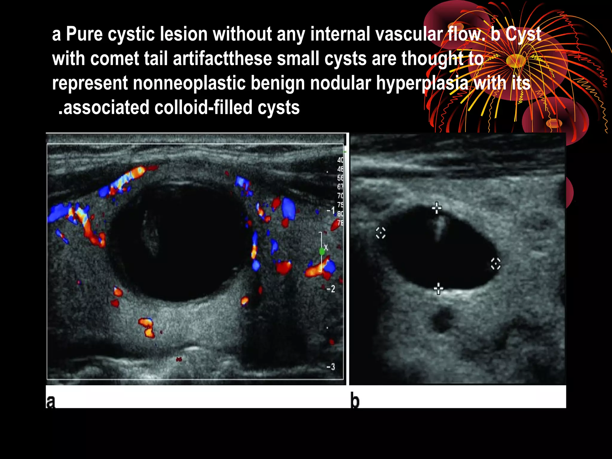 Thyroid ultrasound | PPT