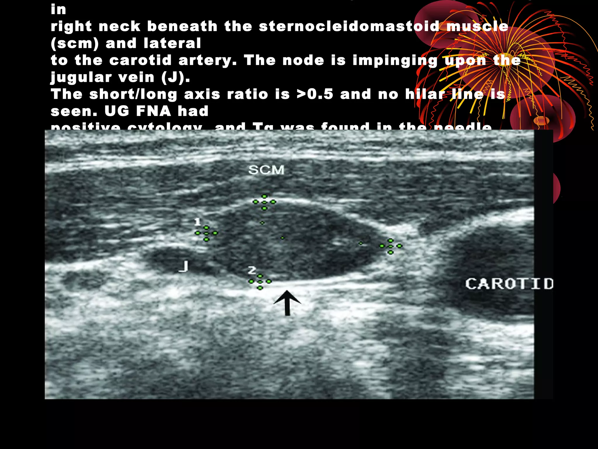 Thyroid ultrasound | PPT