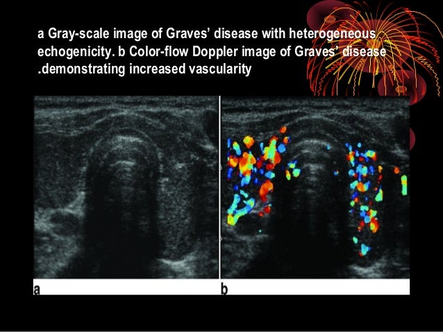 What Do The Colors Mean In A Thyroid Cancer Ultrasound Images With Color