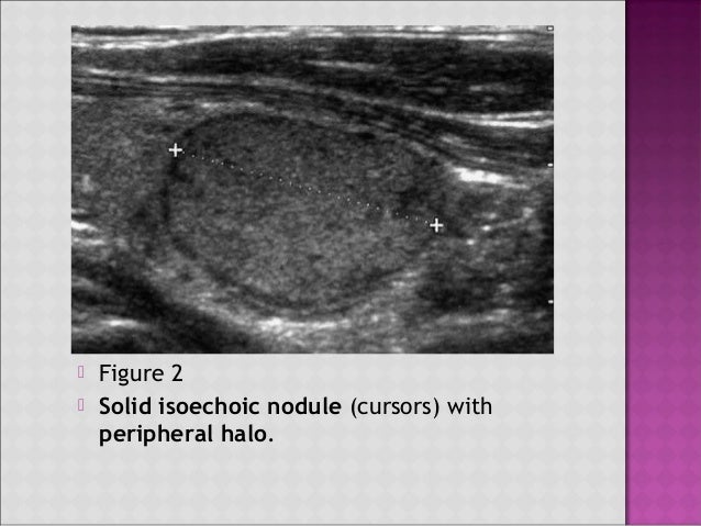 Isoechoic Thyroid Nodule