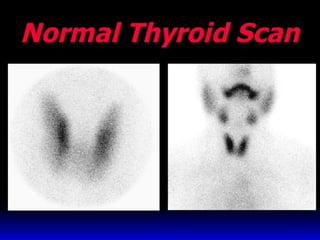 Nuclear Medicine - Thyroid - Procedure/Scan | PPTX