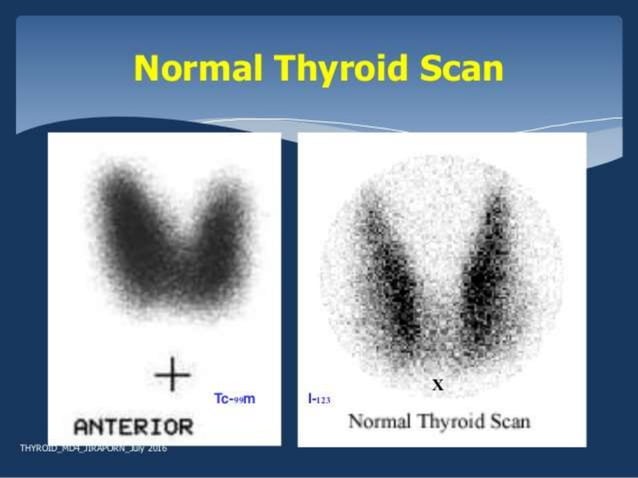 Nuclear Medicine - Thyroid - Procedure/Scan