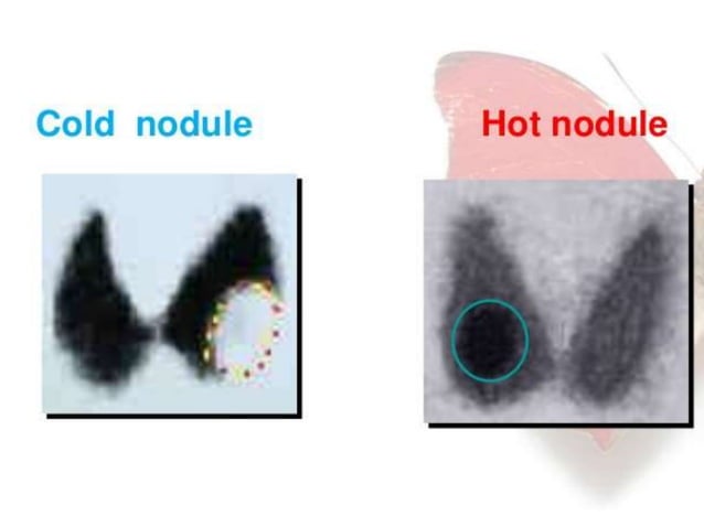 Nuclear Medicine - Thyroid - Procedure/Scan