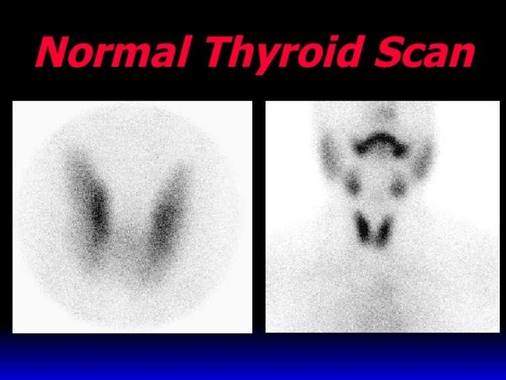Nuclear Medicine - Thyroid - Procedure/Scan