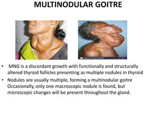 Thyroid | PPTX