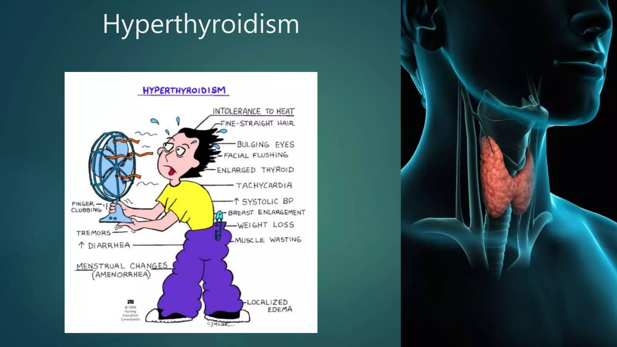 Thyroid | PPTX