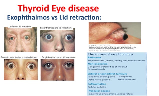 Thyroid History and Physical Examination | PPTX | Thyroid Disorders ...