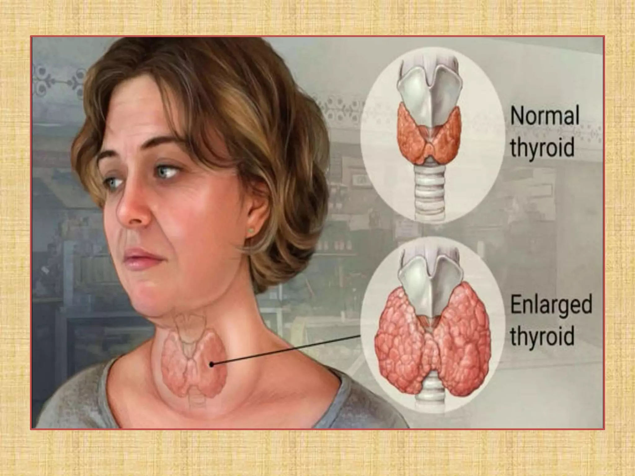 Thyroid | PPTX | Thyroid Disorders | Endocrine and Metabolic Diseases