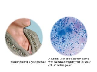 THYROID - cytology pptx | PPTX | Thyroid Disorders | Endocrine and ...