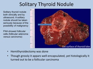 Thyroid.ppsx