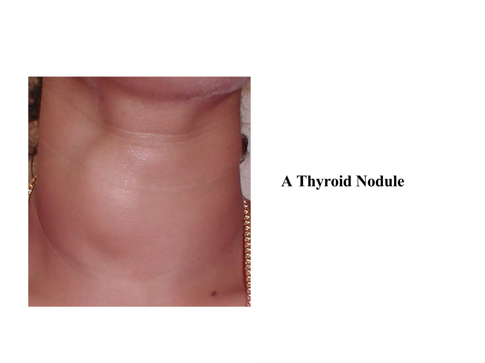 Thyroid | PPT