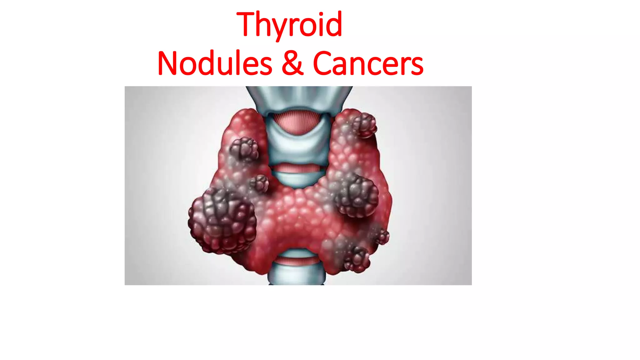 Thyroid-Nodules-Cancers.pptx