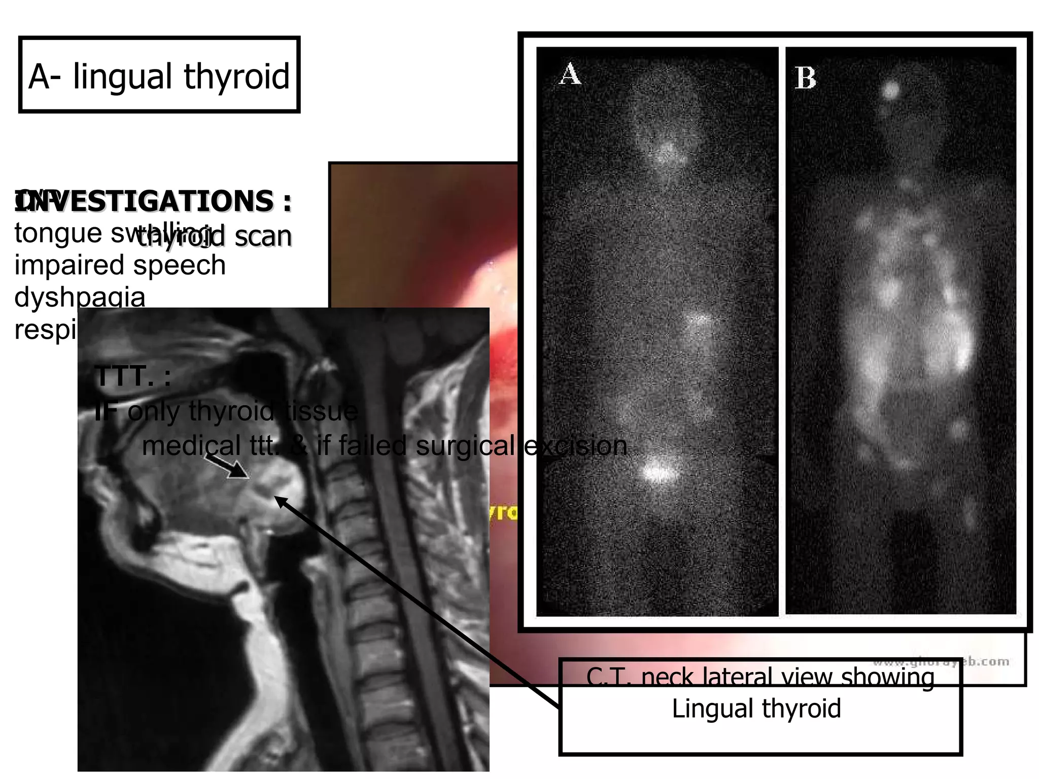Thyroid presentation | PPT